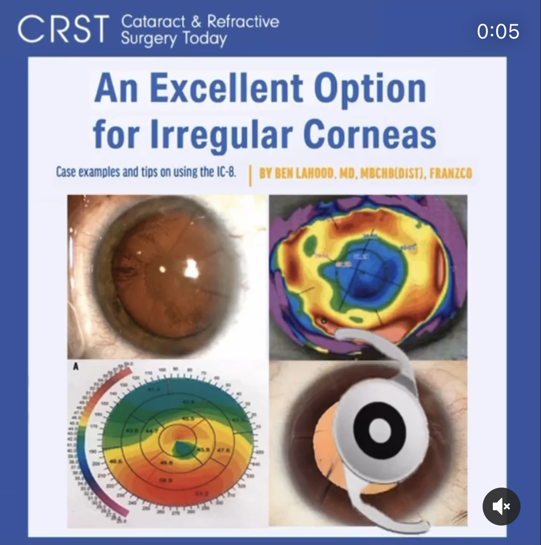 An excellent option for Irregular Corneas - Dr Ben LaHood - Adelaide ...