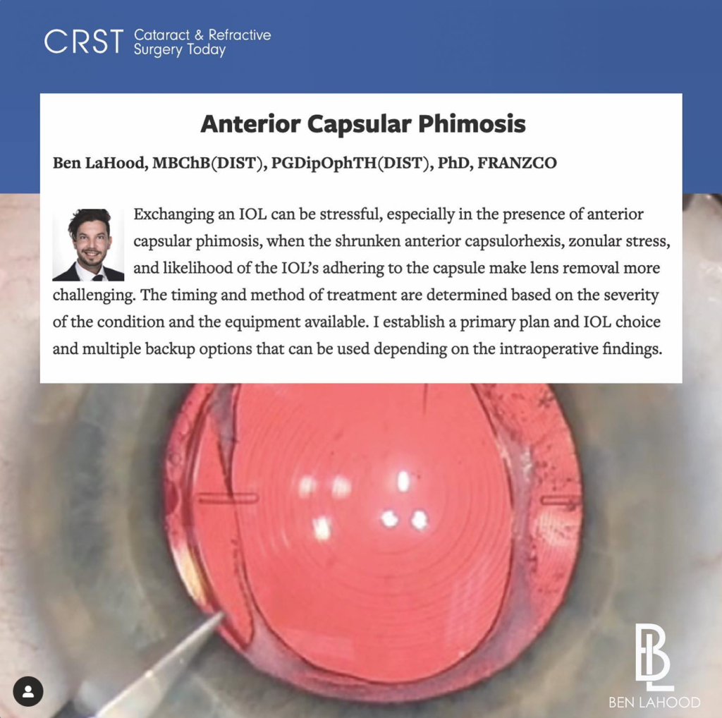 Anterior Capsular Phimosis - Dr Ben LaHood - Adelaide Eye Surgeon